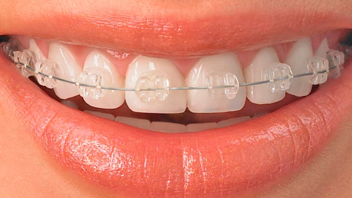 Colori Degli Apparecchi Per I Denti